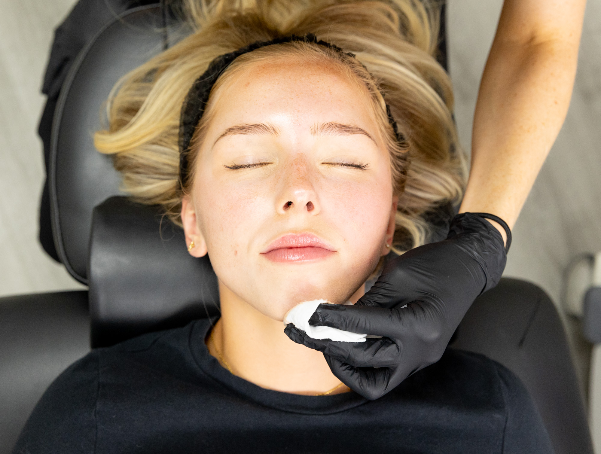IPL Photofacial in Fargo | Total Skin Dermatology & Aesthetics